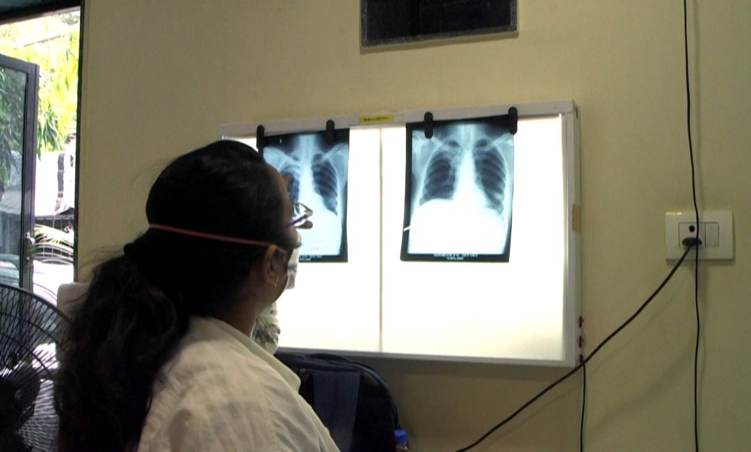 OMS: Casos de tuberculose passaram de 8 milhões no mundo - PIXTV